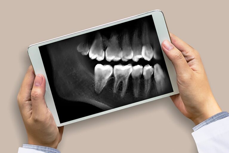 Taking the X-Factor Out of Dental X-Rays | Springs Dental