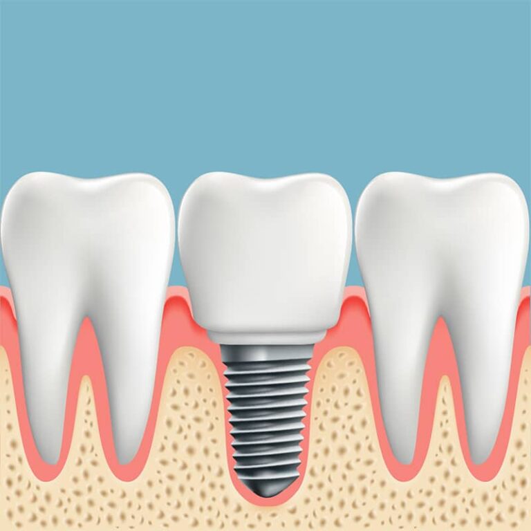 Your Intro to Dental Implants